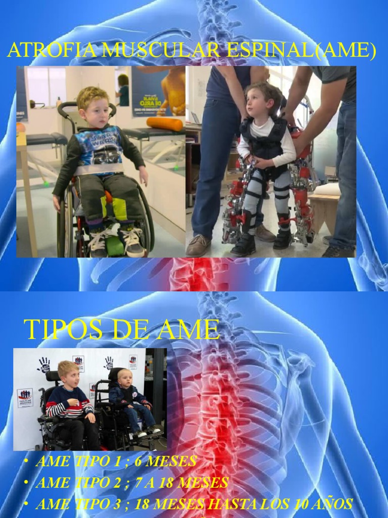 Atrofia Muscular Espinal (Ame) | PDF