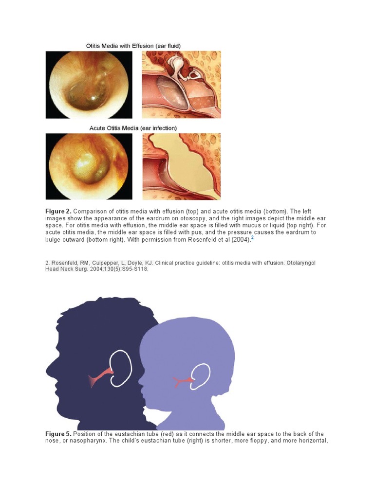 Figure 2. Comparison of Otitis Media With Effusion (Top) and Acute ...