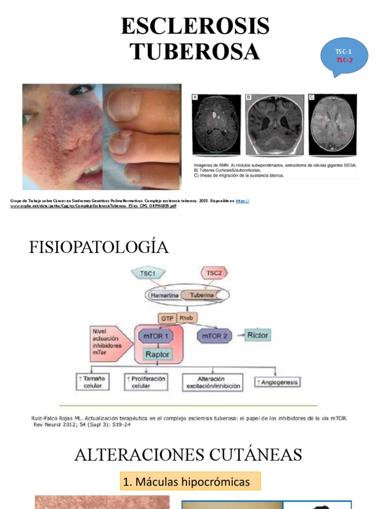 Esclerosis Tuberosa | PDF | Cáncer | Medicina CLINICA