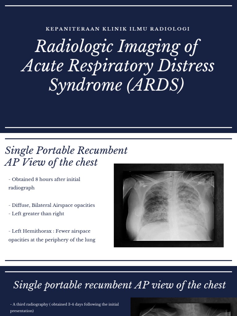 Gambaran Radiologi Pada ARDS | PDF | Ct Scan | Thorax (Human Anatomy)