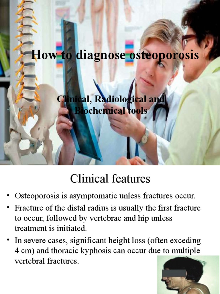 A Comprehensive Guide to Diagnosing Osteoporosis Through Clinical ...