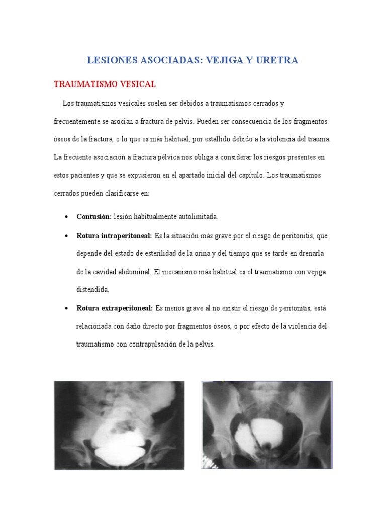 Trauma Pelvico | PDF | Lesión | Pelvis