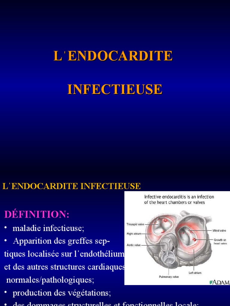 L'endocardite Infectieuse | PDF | Médecine clinique | Immunologie