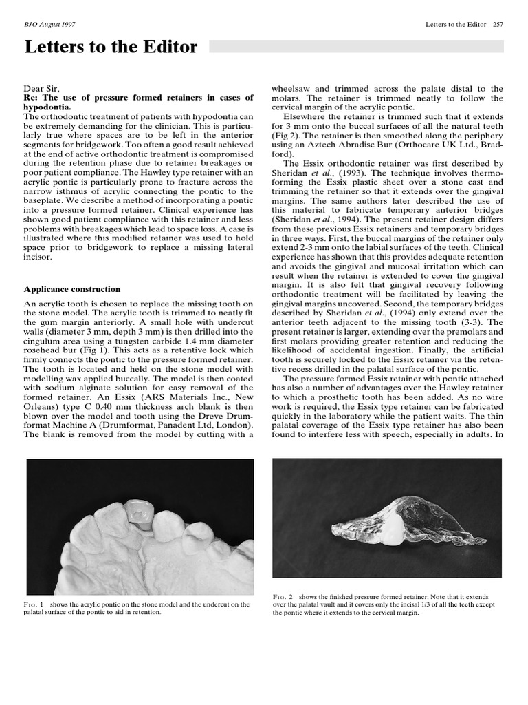 Pressure formed Essix retainers for hypodontia cases | PDF | Dentistry ...