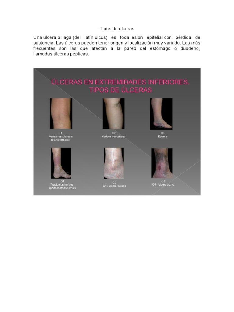 Tipos de Ulceras | PDF | Arte