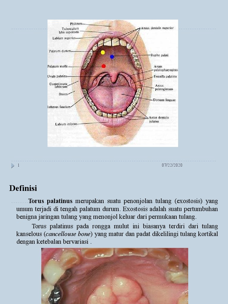 Torus Palatinus | PDF