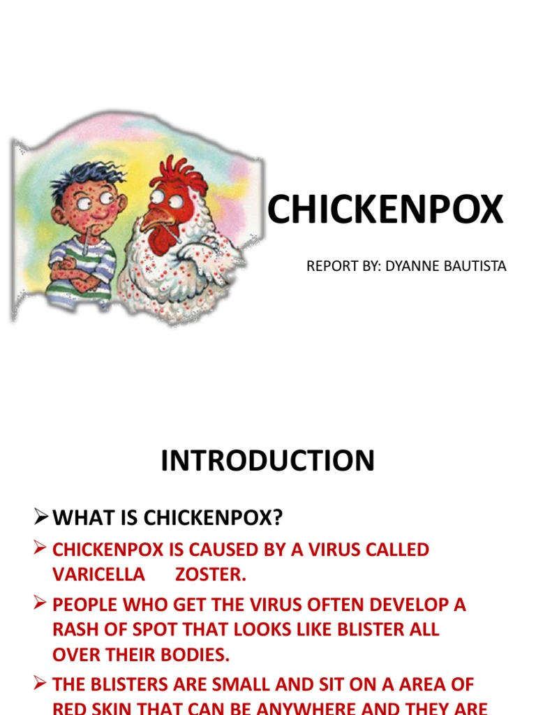 Chicken Pox Report | PDF | Rtt | Public Health