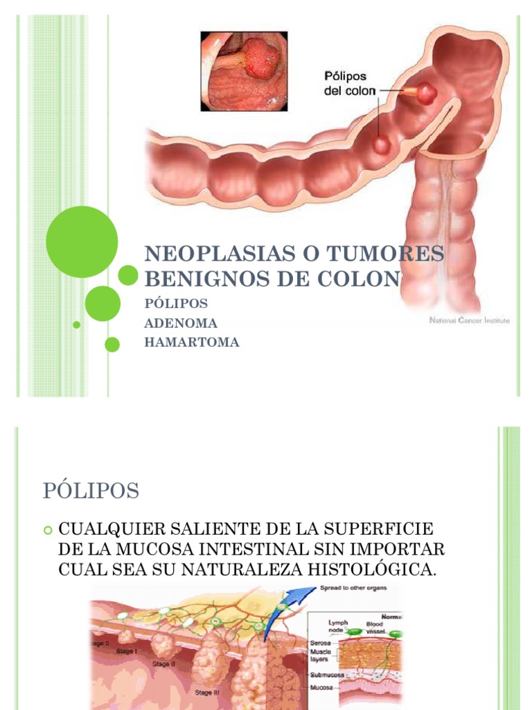 Neoplasias o Tumores Benignos de Colon | PDF | Cáncer colonrectal | Enfermedades digestivas