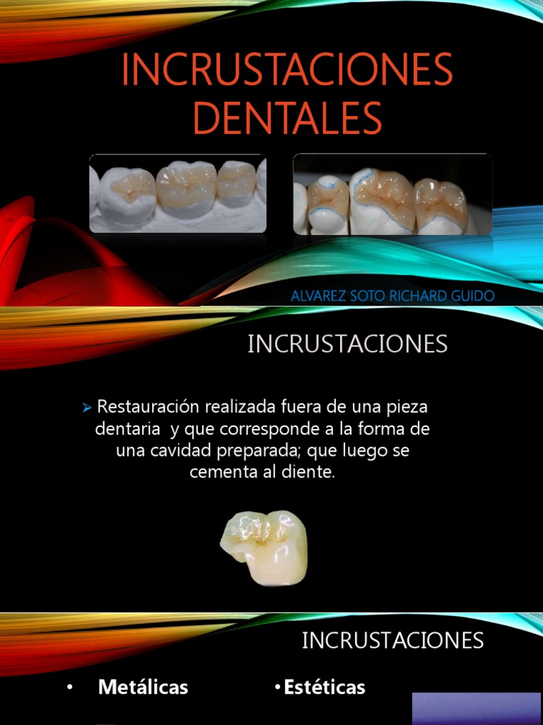 Incrustaciones | PDF | Esmalte de dientes | Odontología