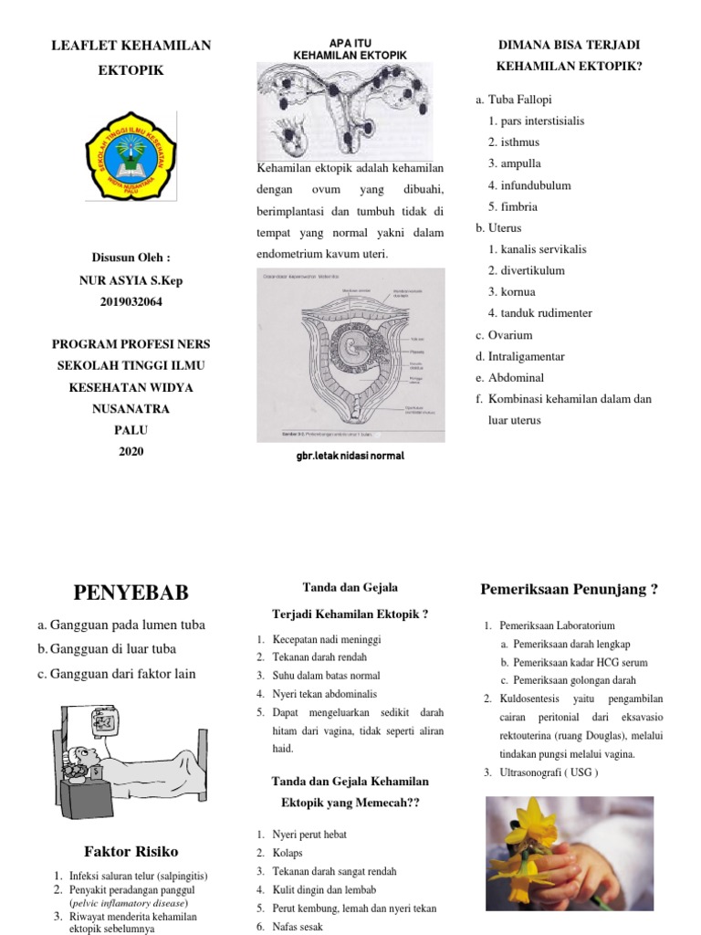 Leaflet Kehamilan Ektopik | PDF