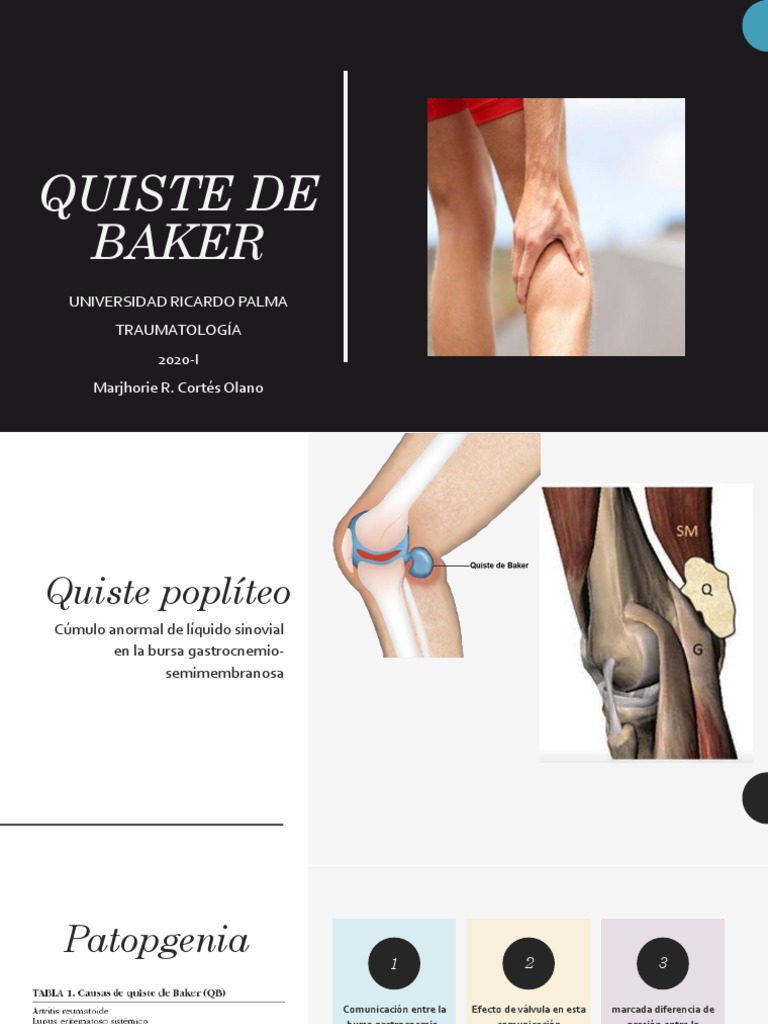 Quiste de Baker PDF | Descargar gratis PDF | Rodilla | Medicina