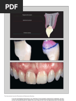 Stump Shade Tips for Dentists | PDF | Tooth | Tooth Enamel