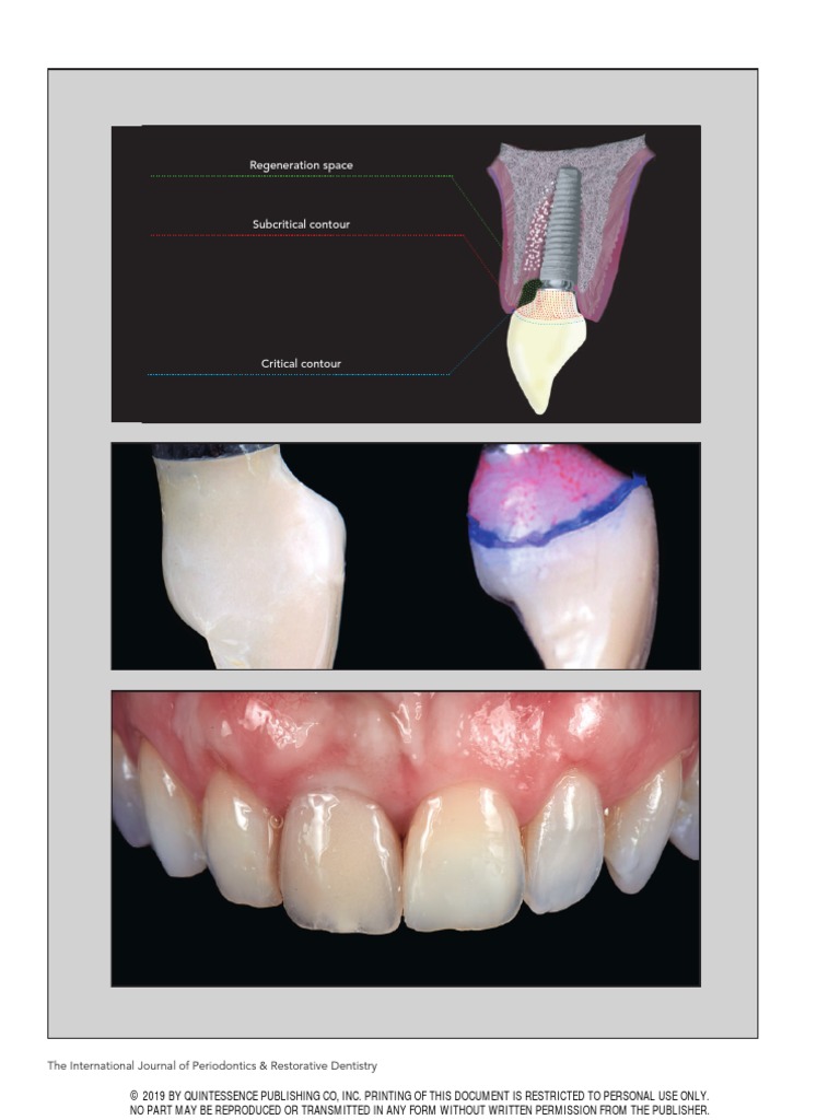 2020 Emergence Profile Guidelines PDF | PDF | Dental Implant ...