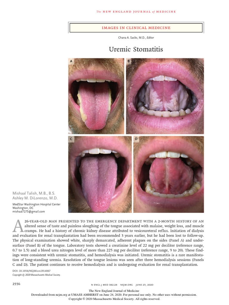 Uremic Stomatitis