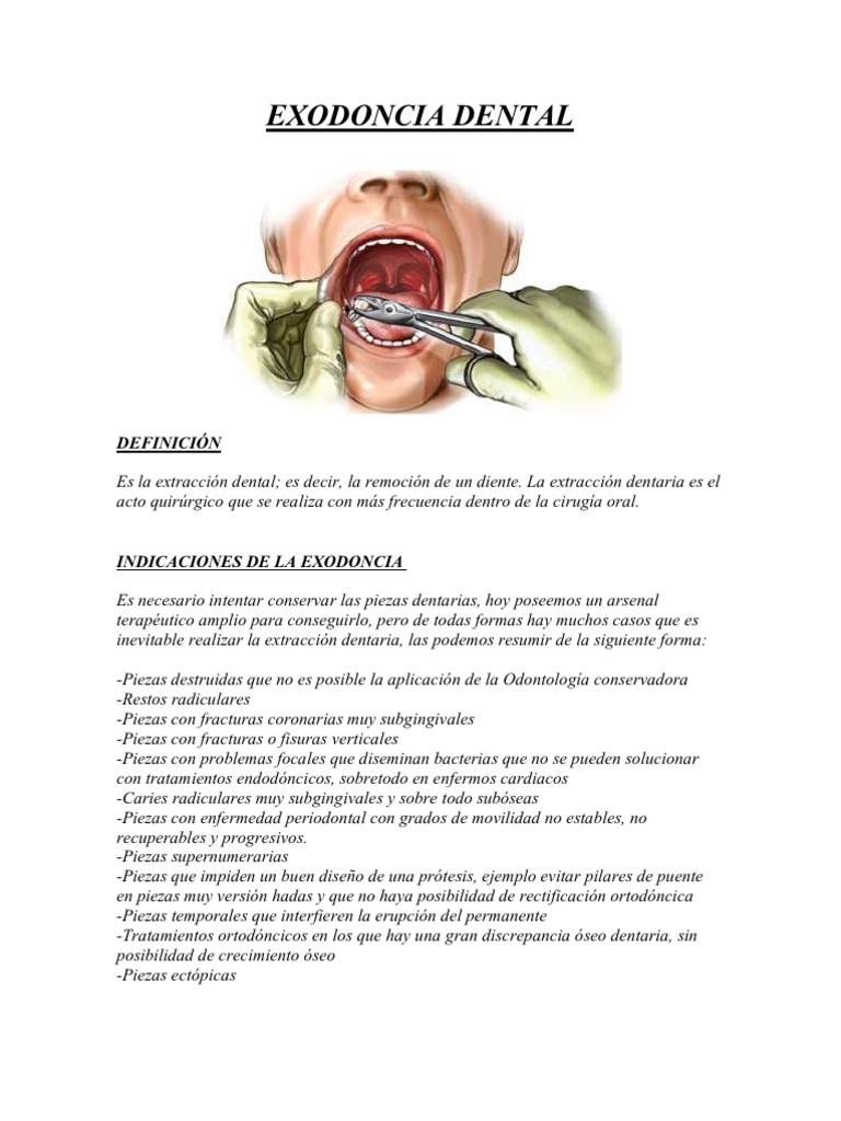 Exodoncia Dental