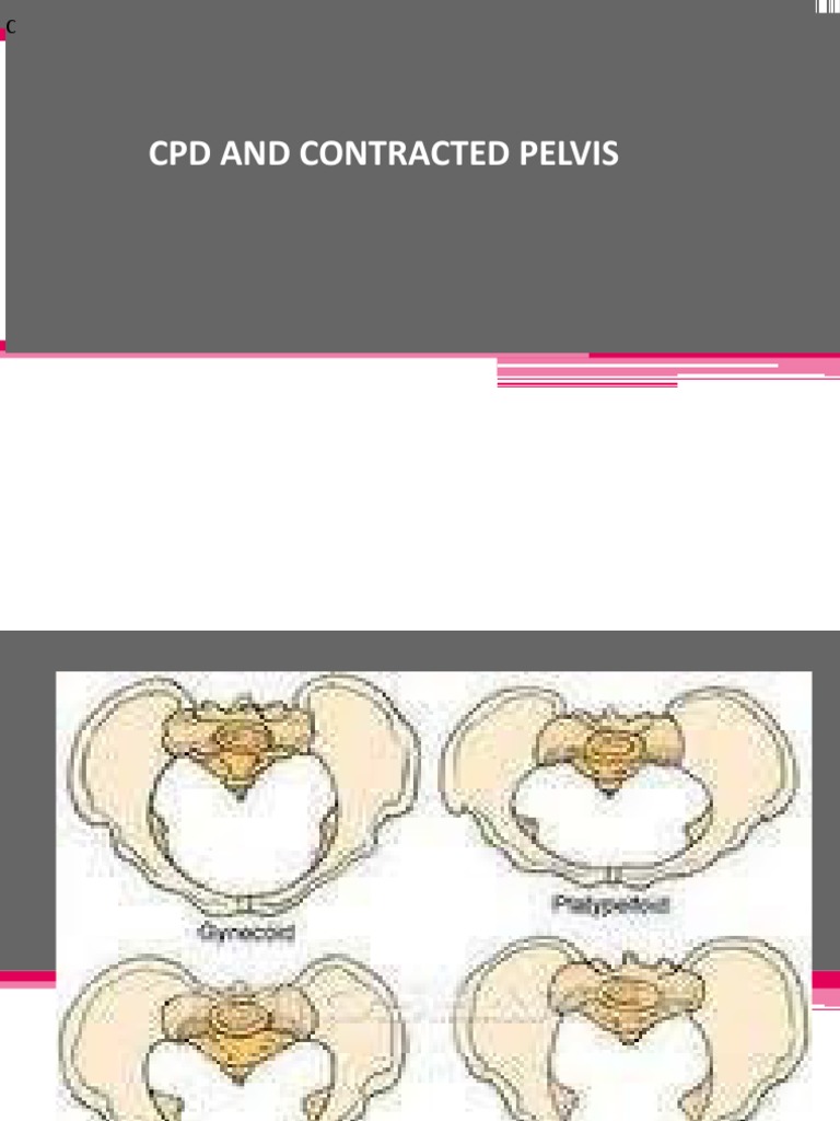 CPD and Contracted Pelvis | PDF | Pelvis | Caesarean Section