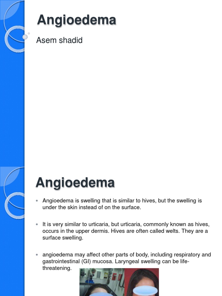 Angioedema 4 | PDF | Immunology | Rtt