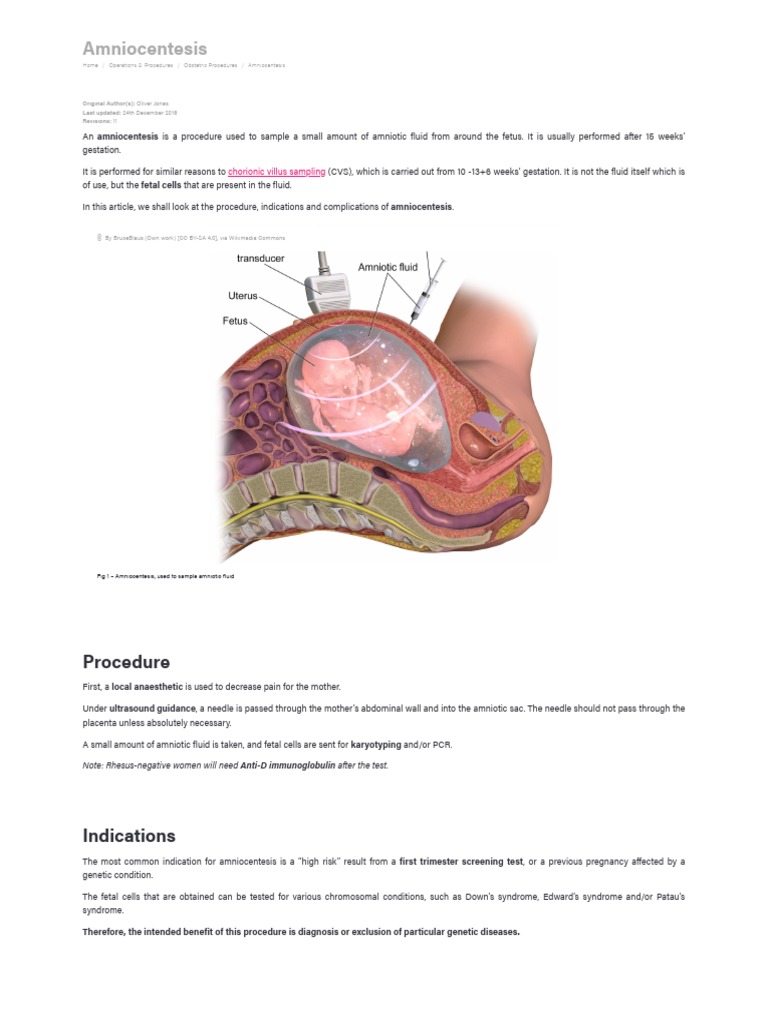 Amniocentesis - Indications - Complications - Procedure - TeachMeObGyn ...