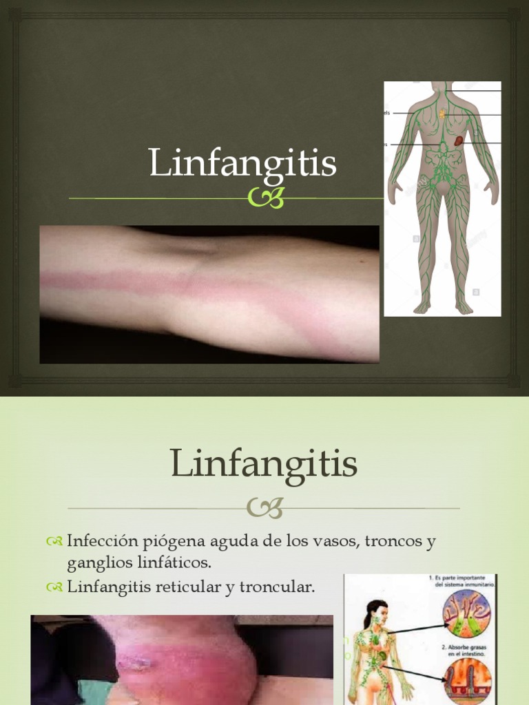 Linfangitis: Causas, Síntomas y Tratamiento | PDF | Septicemia ...
