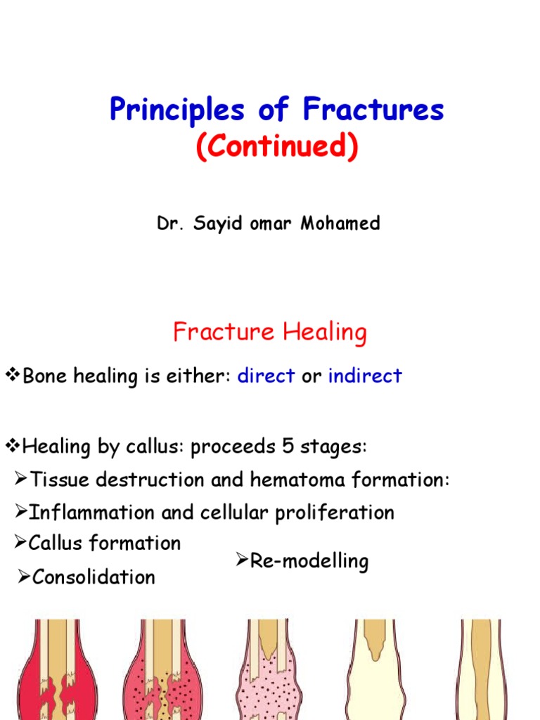 Principles of Fractures: (Continued) | PDF | Physiology | Health Sciences
