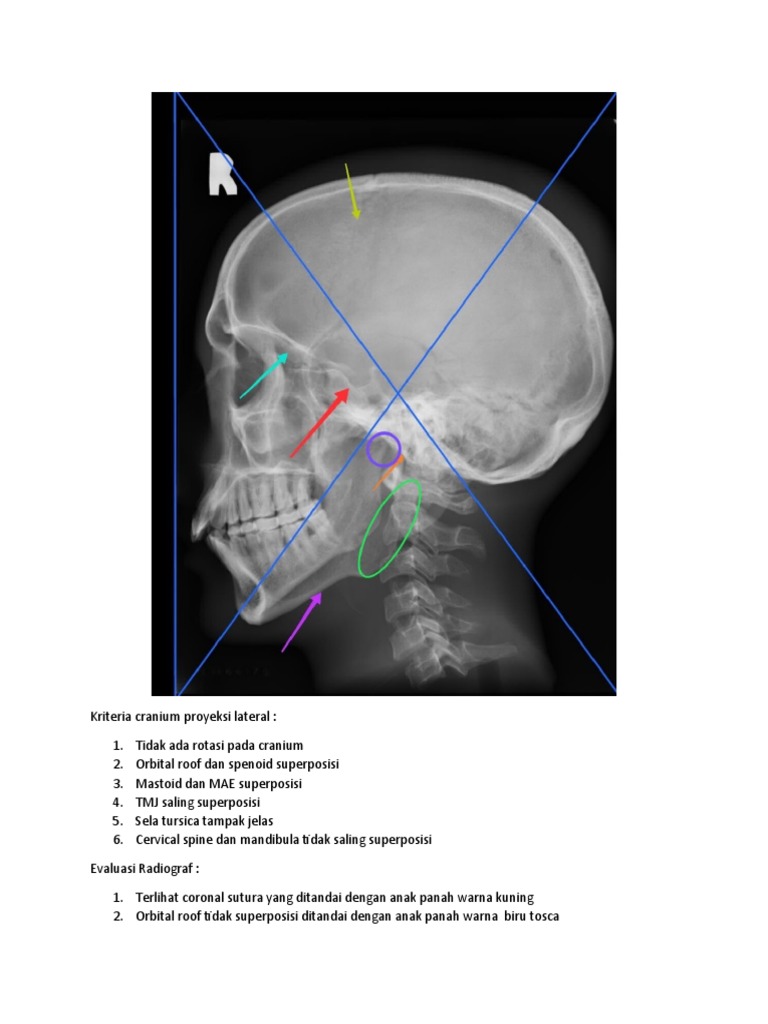 Kriteria Proyeksi Lateral Cranium | PDF