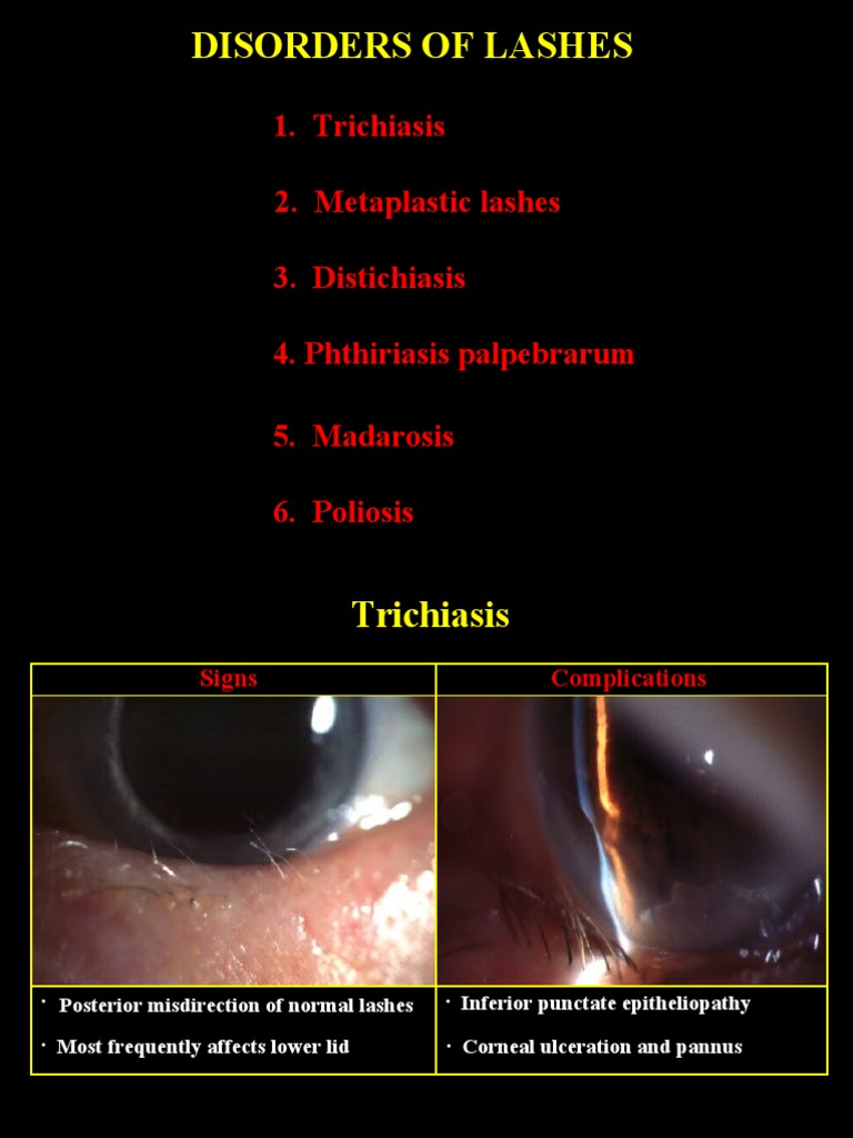 Disorders of Lashes: 1. Trichiasis 2. Metaplastic Lashes 3 ...