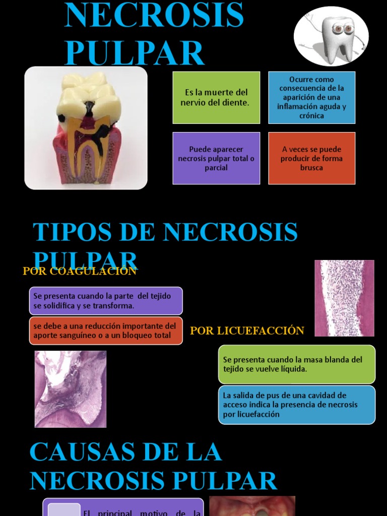 Necrosis Pulpar | PDF | Rtt | Epidemiología