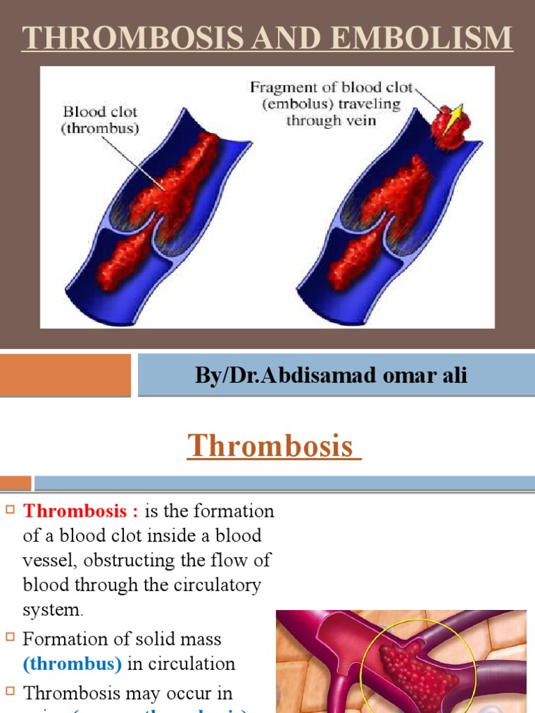 Thrombosis and Embolism | PDF