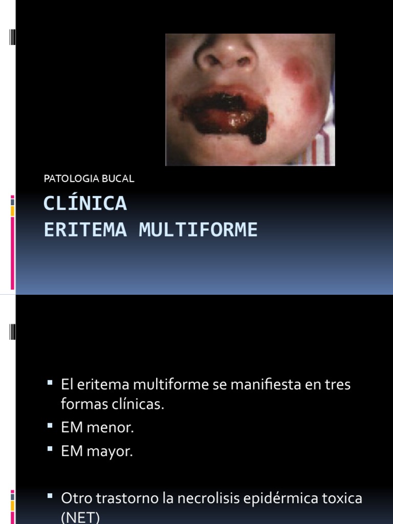 Eritema Multiforme: Guía Clínica | PDF