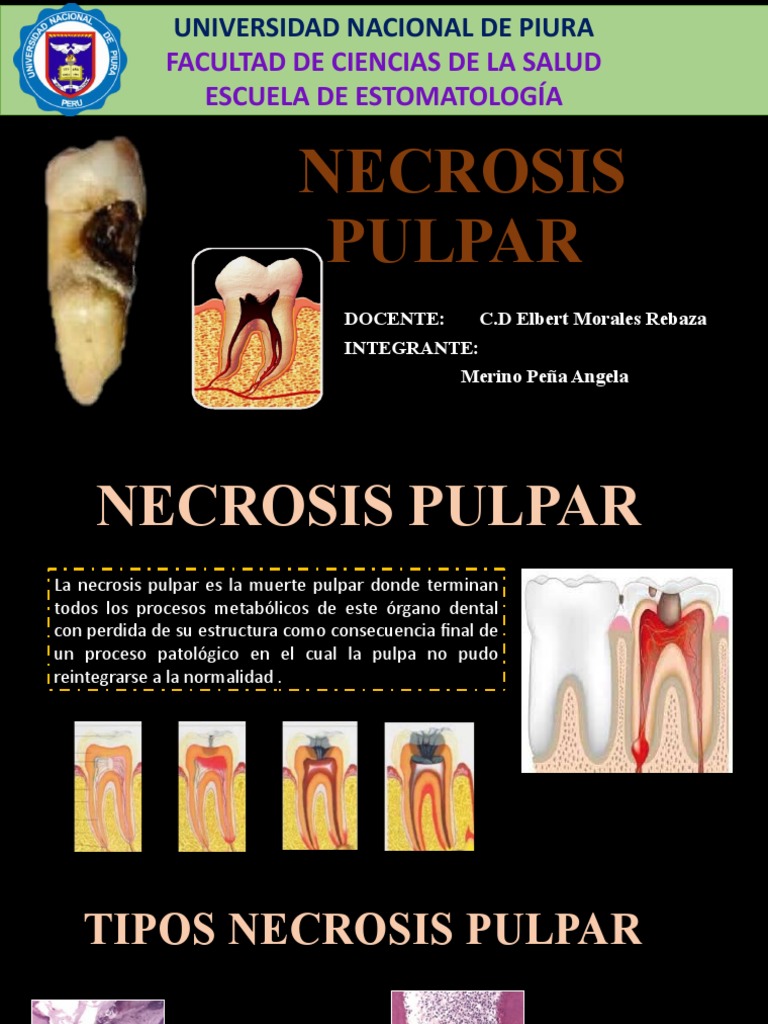 Necrosis Pulpar: Causas y Tratamientos | PDF | Enfermedades y ...