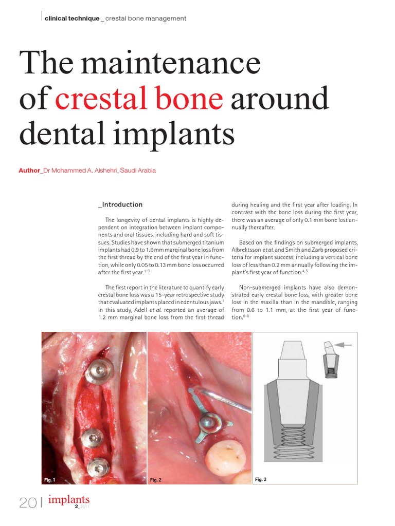 Crestal Bone: The Maintenance of Around Dental Implants | PDF | Dental ...