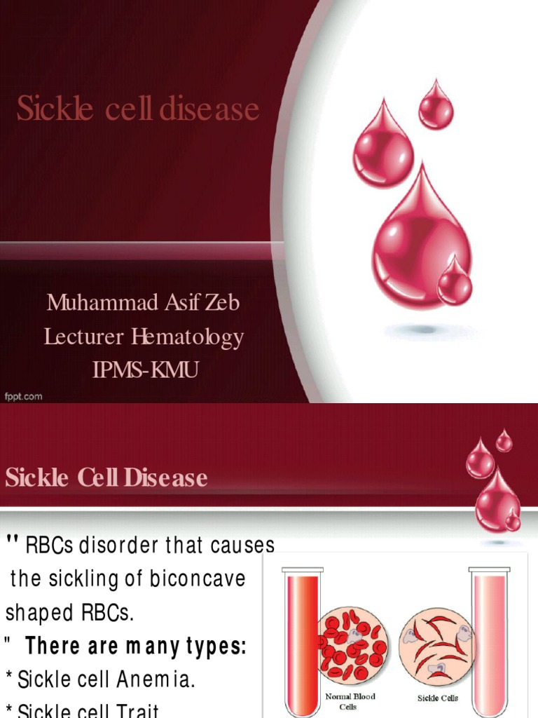 Sickle Cell Disease | PDF | Medical Specialties | Clinical Medicine