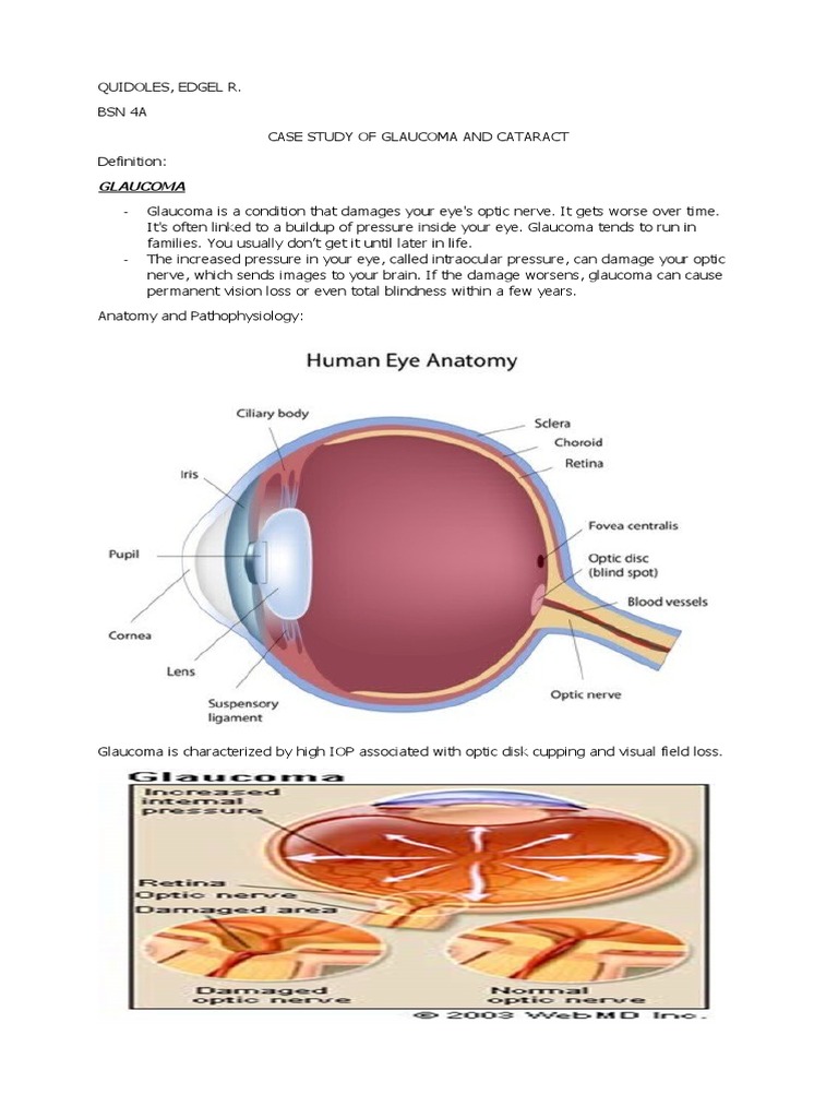 Glaucoma Case Study | PDF | Glaucoma | Ophthalmology