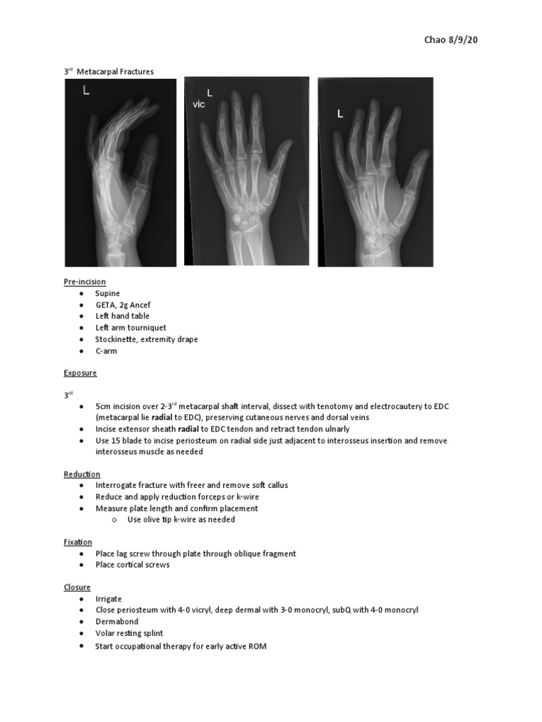 3rd Metacarpal Fracture | PDF