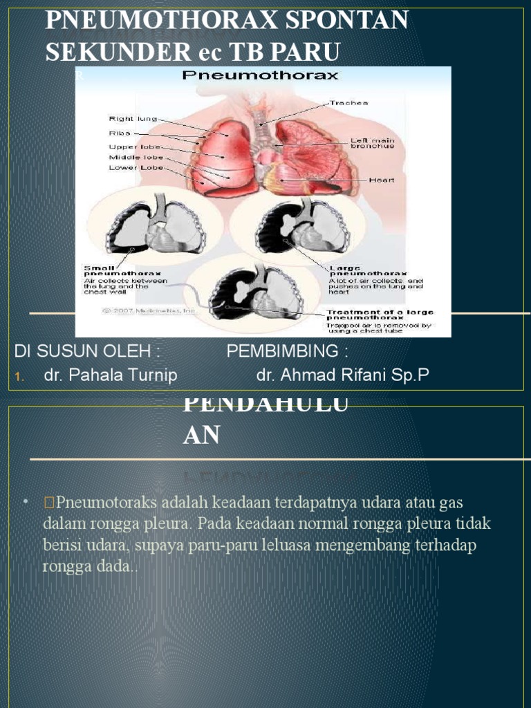 Pneumothorax 2 | PDF