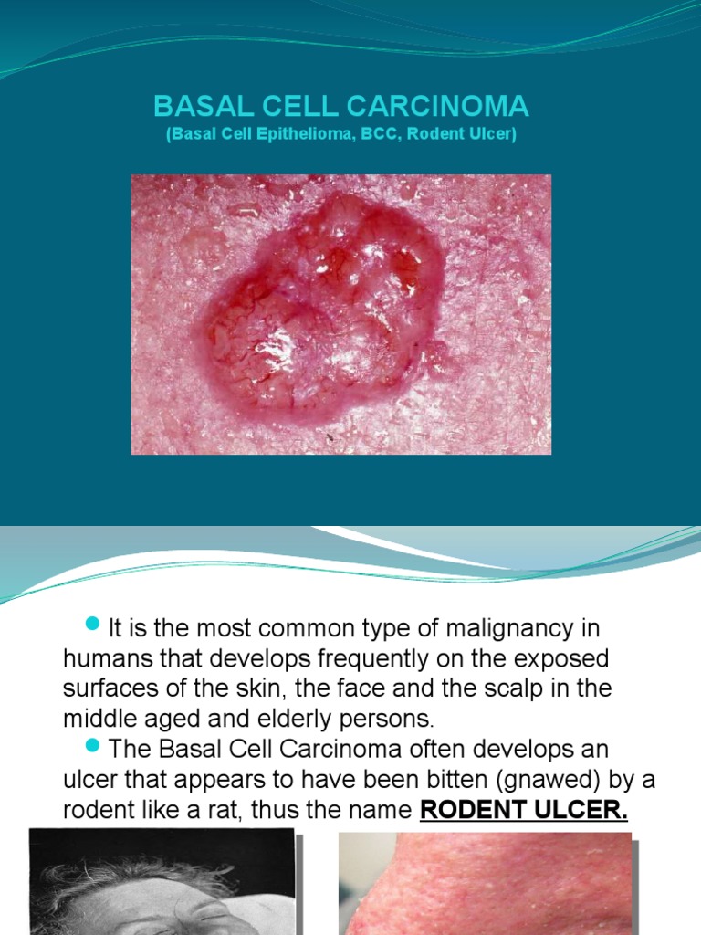 Basal Cell Carcinoma | PDF | Carcinoma | Integumentary System