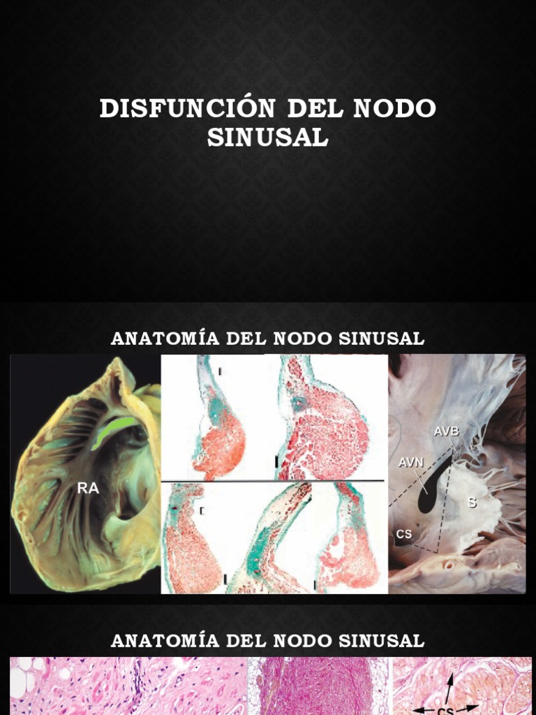 Disfunción Del Nodo Sinusal | PDF | Enfermedades cardiovasculares ...