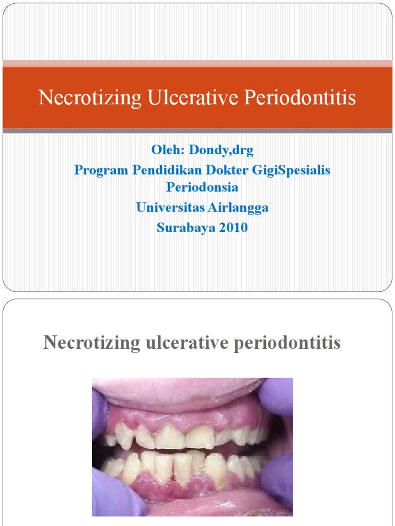 Necrotizing Ulcerative Periodontitis | PDF