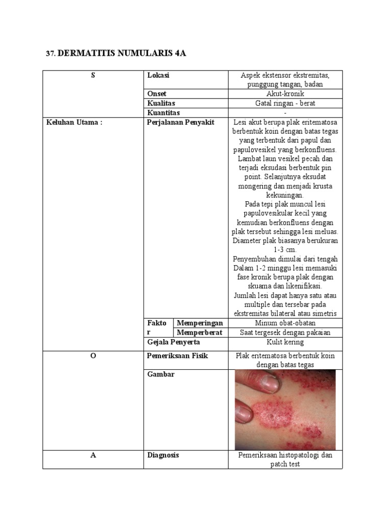 Dermatitis Numularis 4A | PDF