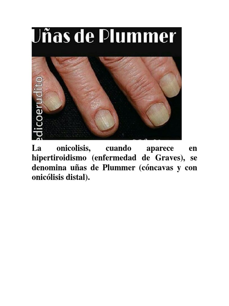 Uñas de Plummer PDF | PDF