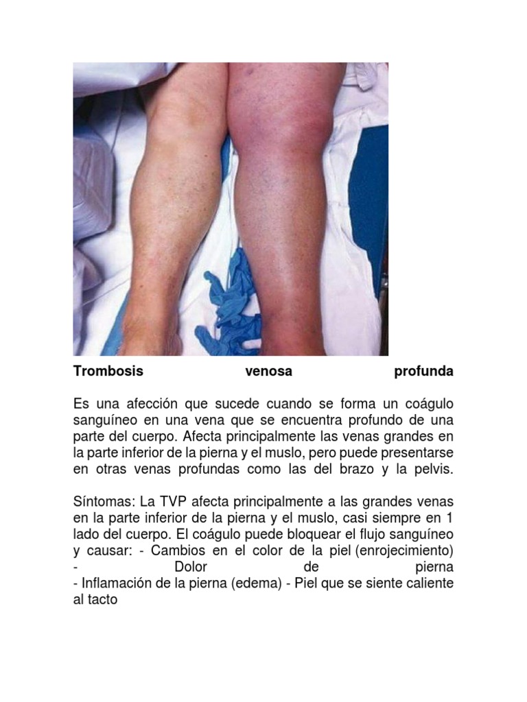Trombosis Venosa Profunda PDF | PDF | Viajes y turismo | Historia