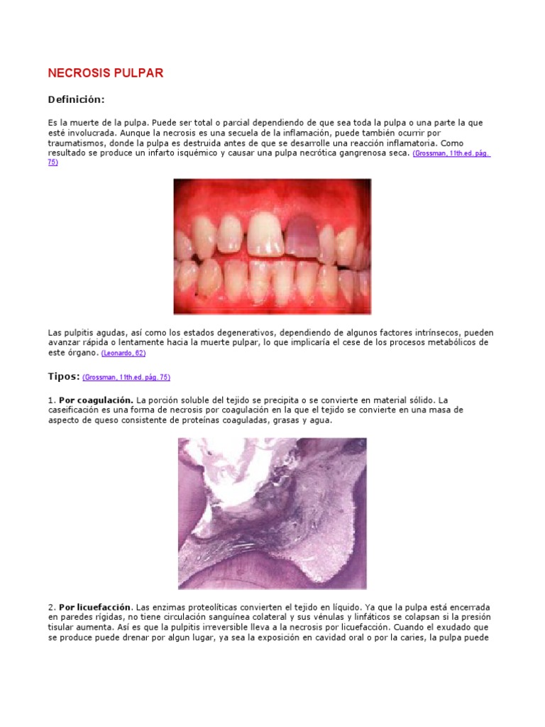 Necrosis Pulpar | PDF | Descomposición | Las bacterias