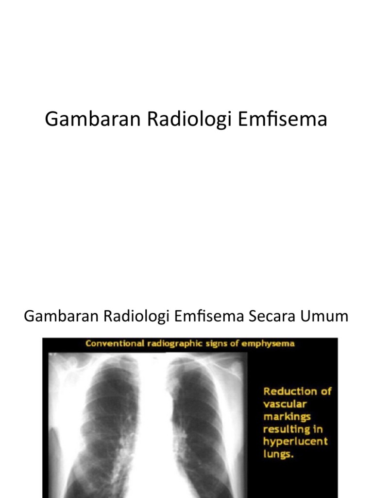 Gambaran Radiologi Emfisema | PDF