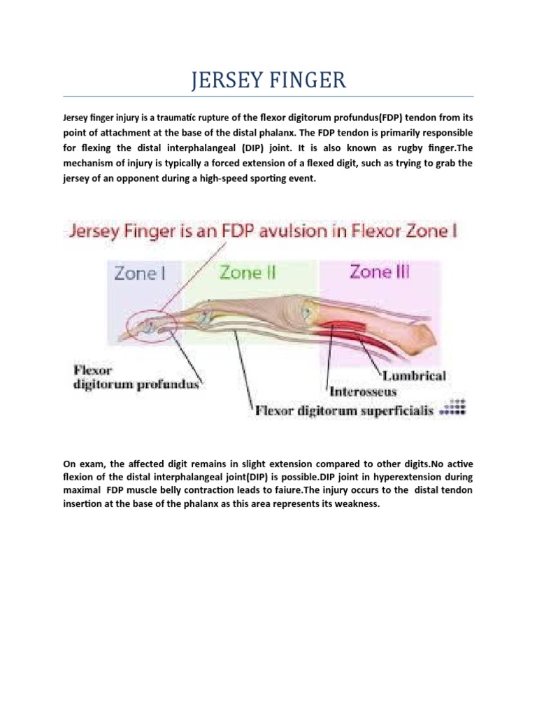 Jersey Finger Injury Is A Traumatic Rupture | PDF