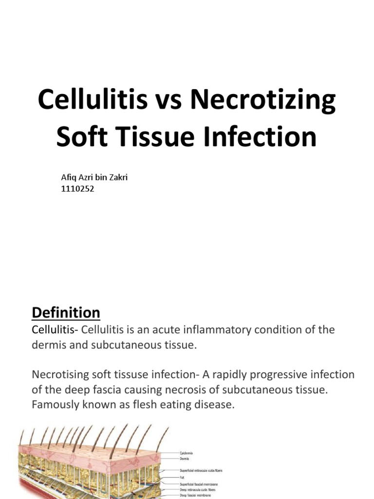 Cellulitis Vs Necrotizing Soft Tissue Infection: Afiq Azri Bin Zakri ...