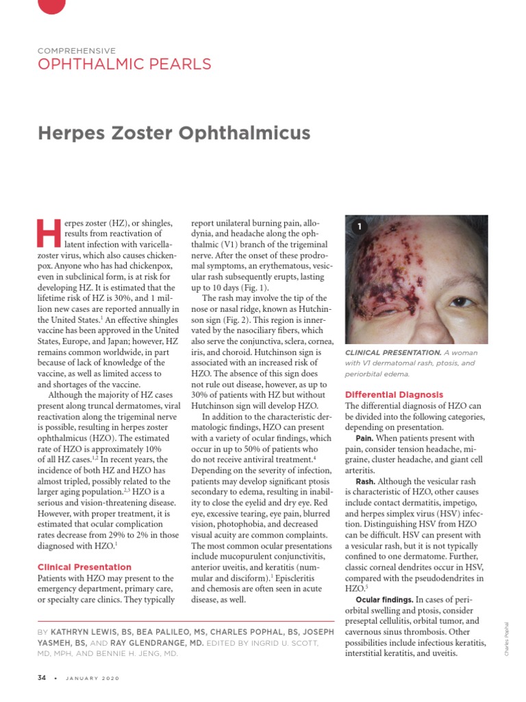 Herpes Zoster Ophthalmicus: Ophthalmic Pearls | PDF | Ophthalmology | Clinical Medicine