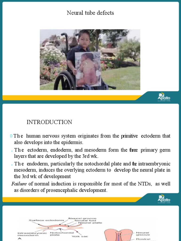 Neural Tube Defect | PDF | Human Diseases And Disorders | Medicine