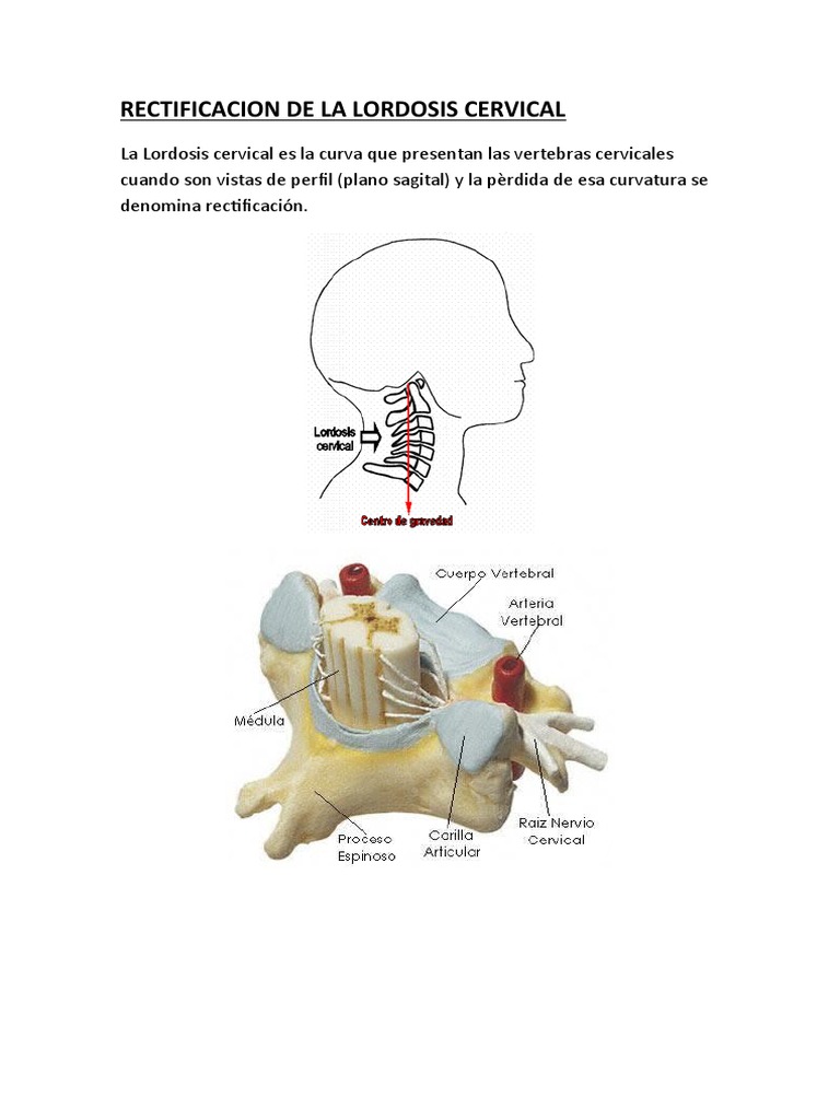 RECTIFICACION DE LA LORDOSIS CERVICAL