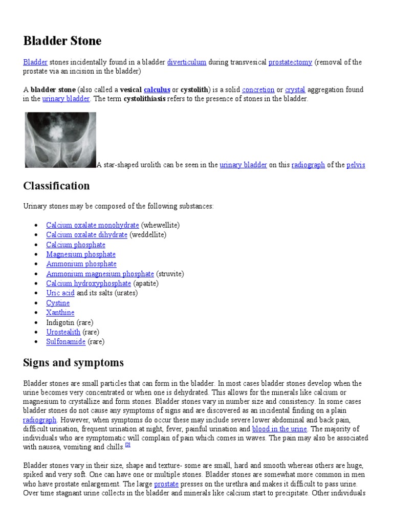 A Comprehensive Review of Bladder Stones, Cystitis, and Associated ...