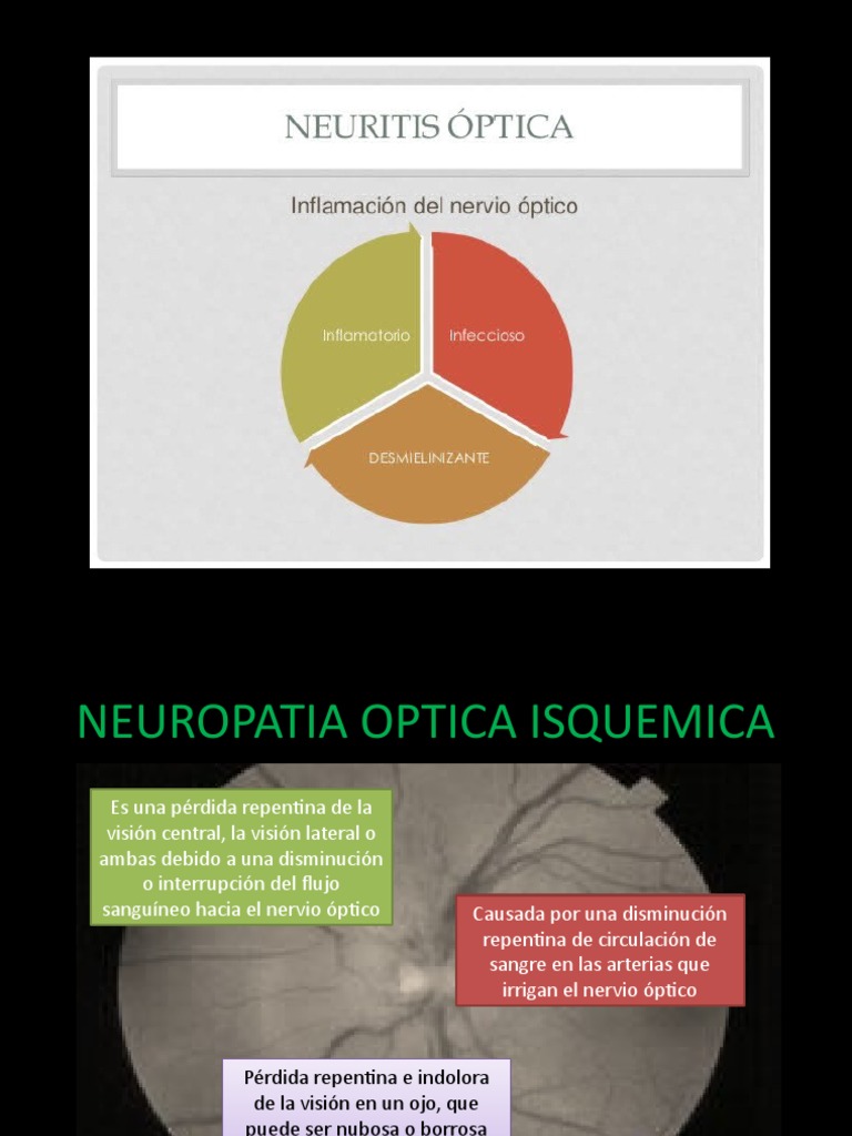 Neuropatía óptica: causas, síntomas y tratamiento | PDF | Medicina ...